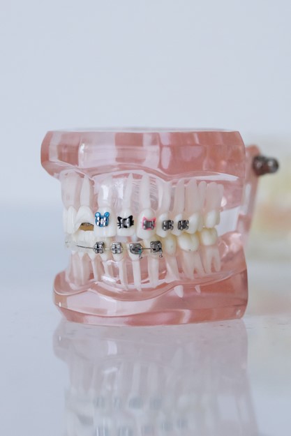 Is Single Arch Treatment Possible with Traditional Braces?